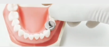 Mesio Distal Guide Kit – Nomad Medical Supply